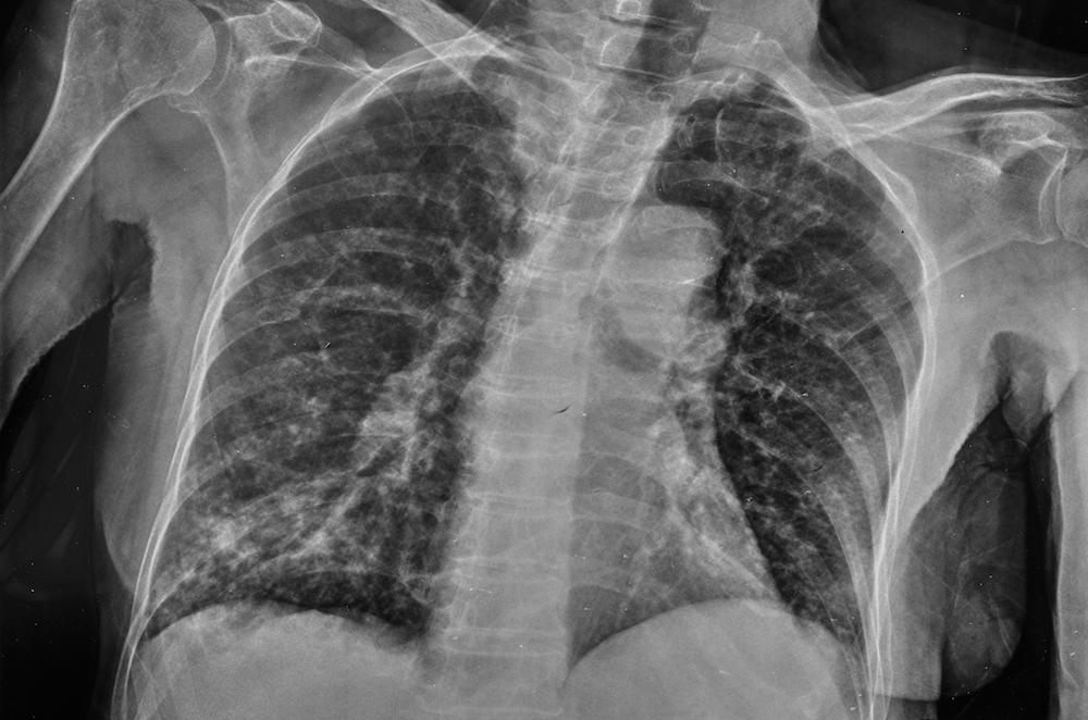 Chiropractic, Backpain and Structural Radiographs - Advanced ...